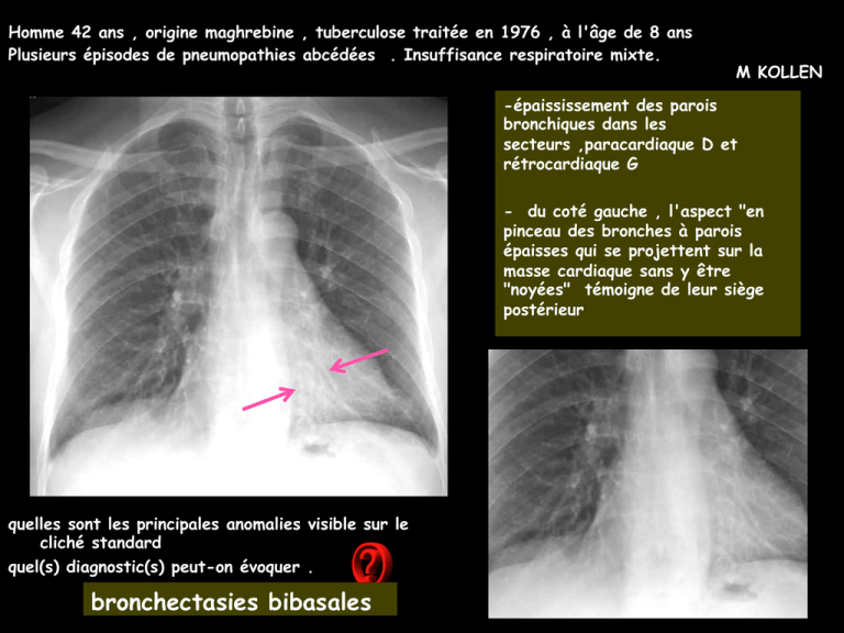 bronchectasies bibasales